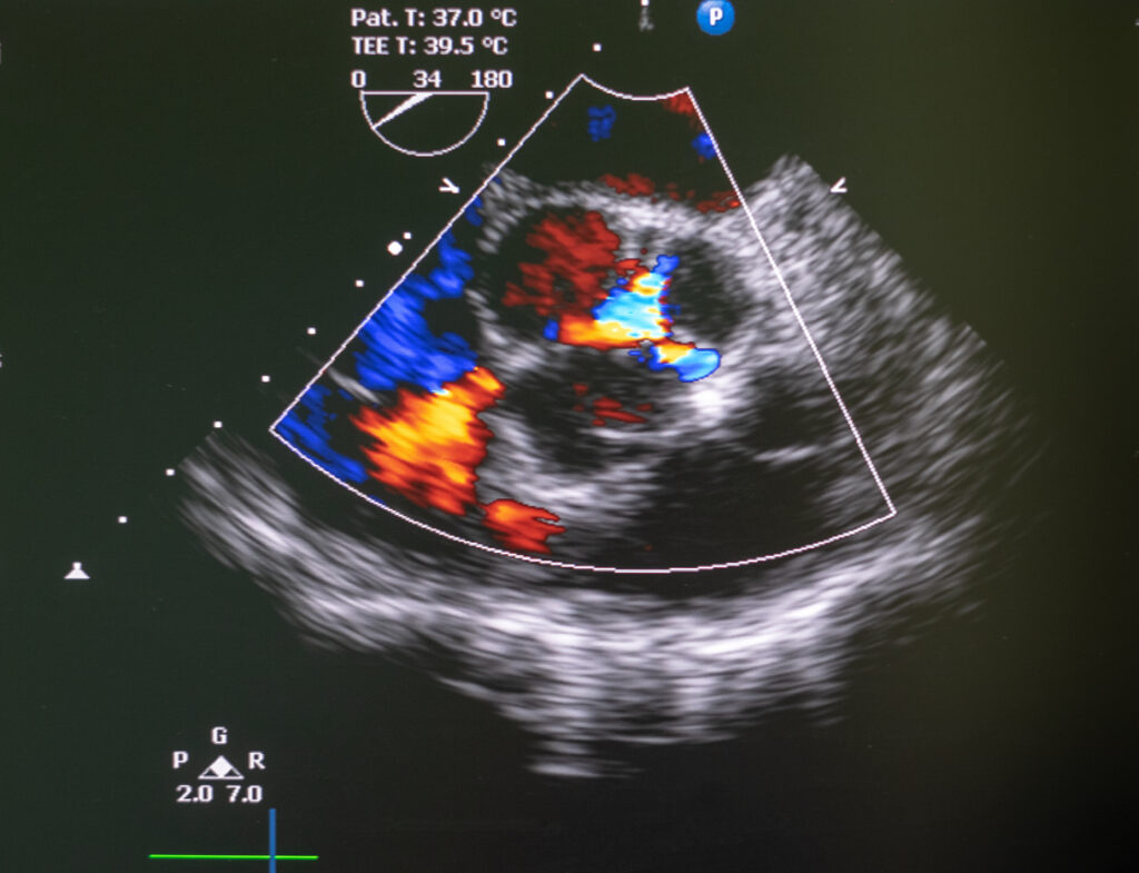 Perioperative Echocardiographic Strain Analysis - Louisiana Anesthesia ...